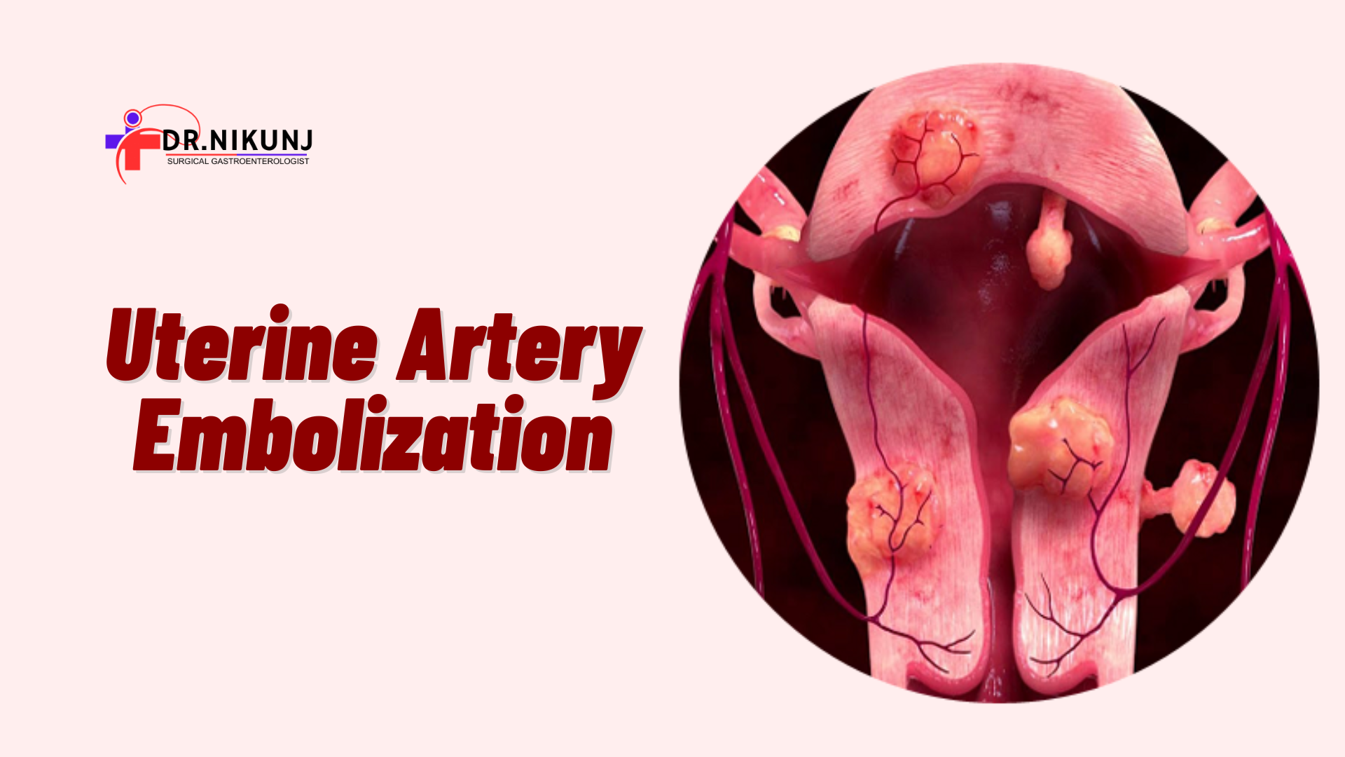 Uterine Artery Embolization